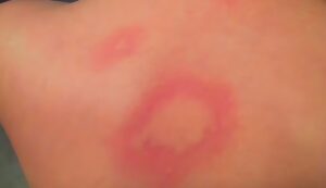 What Are the Common Signs and Symptoms of Vape Rashes?